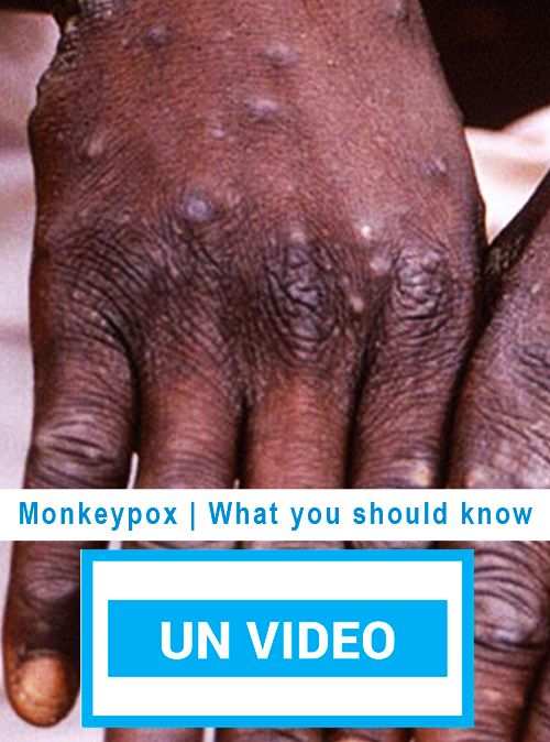 Monkeypox | What you should know - Documentary Watch